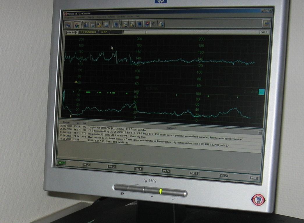 Electronic Fetal Monitoring: The Risks - Birth Injury Guide