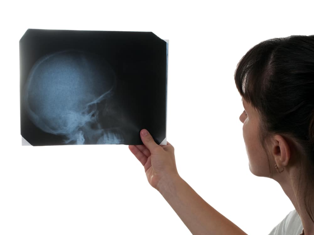Infant Skull Fractures | Birth Injury Guide