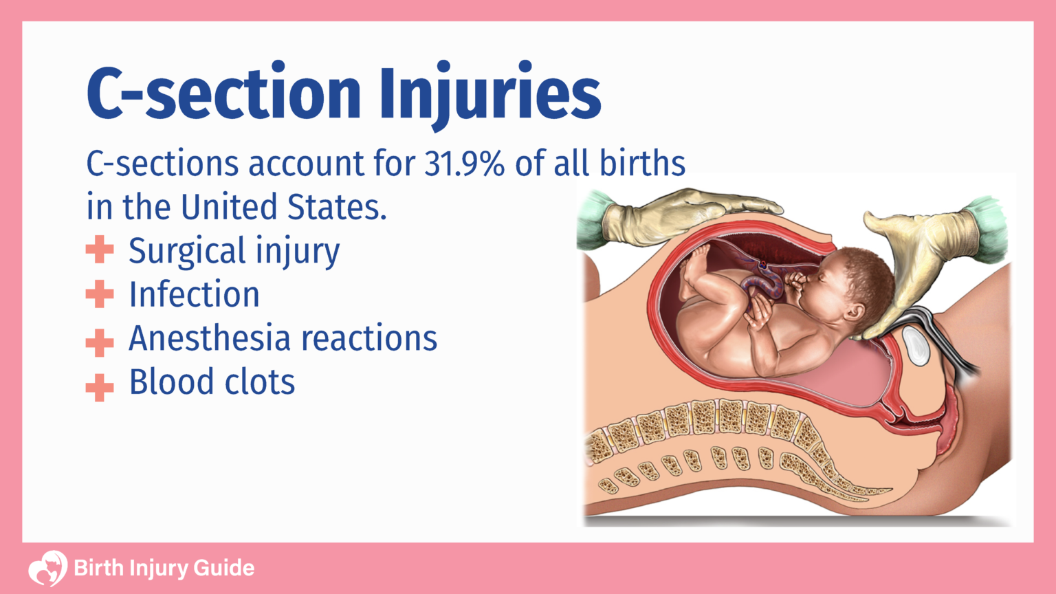 C-Section Injuries: Risks and Complications | Birth Injury Guide