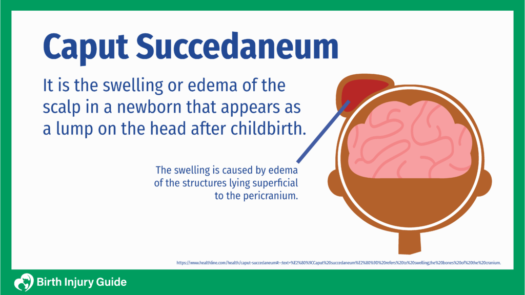 Caput Succedaneum: Causes, Treatment and More - Birth Injury Guide