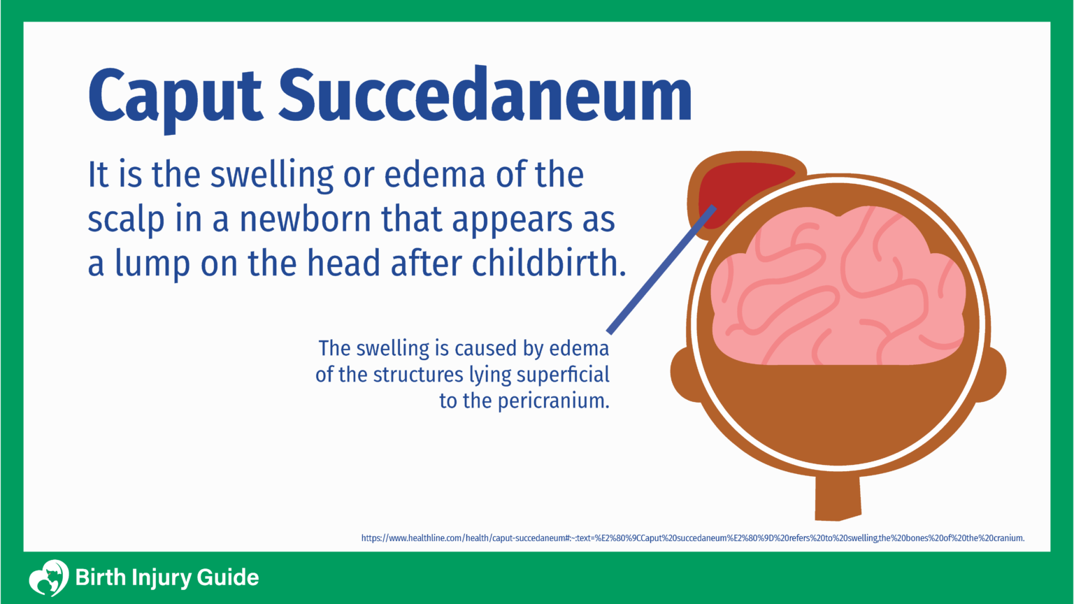 Caput Succedaneum: Causes, Treatment and More - Birth Injury Guide