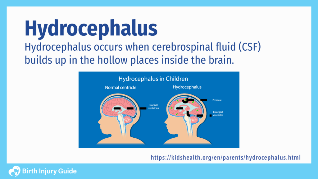 Hydrocephalus | Birth Injury Guide