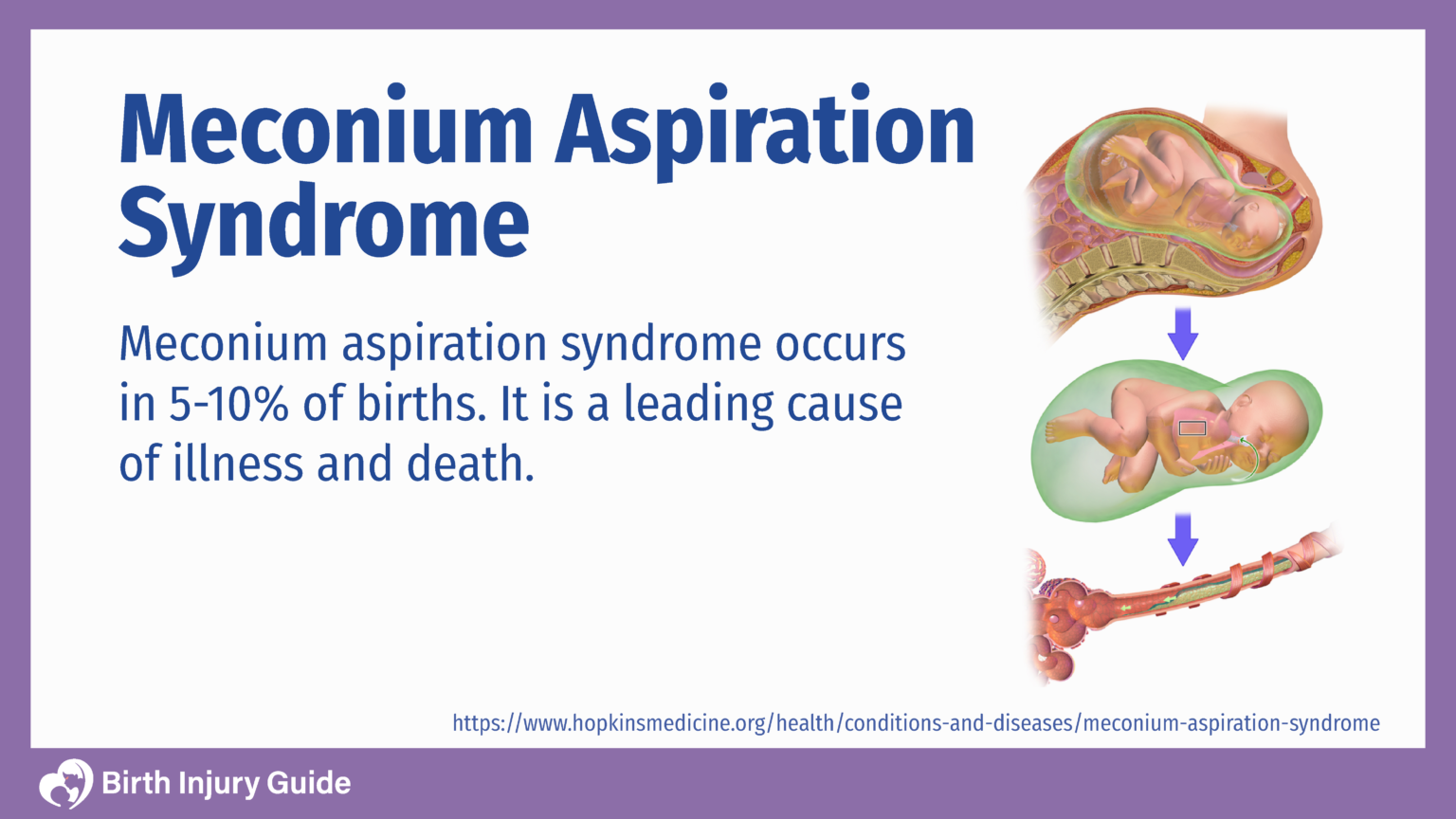 Meconium Aspiration Syndrome (MAS) | Birth Injury Guide