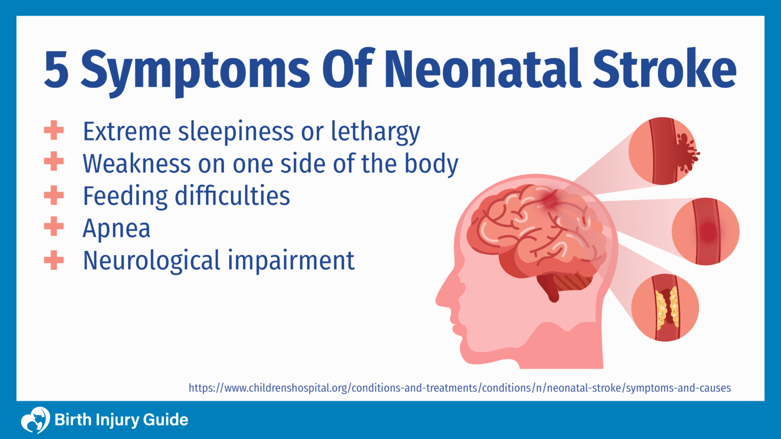 Neonatal Stroke | Birth Injury Guide
