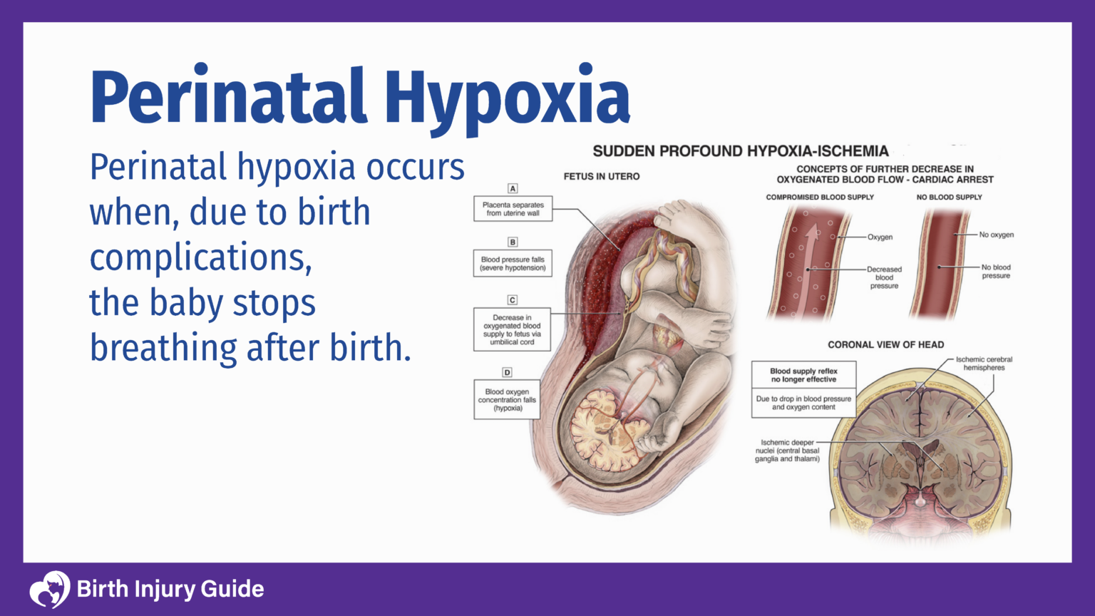 What Is Perinatal Hypoxia | Birth Injury Guide