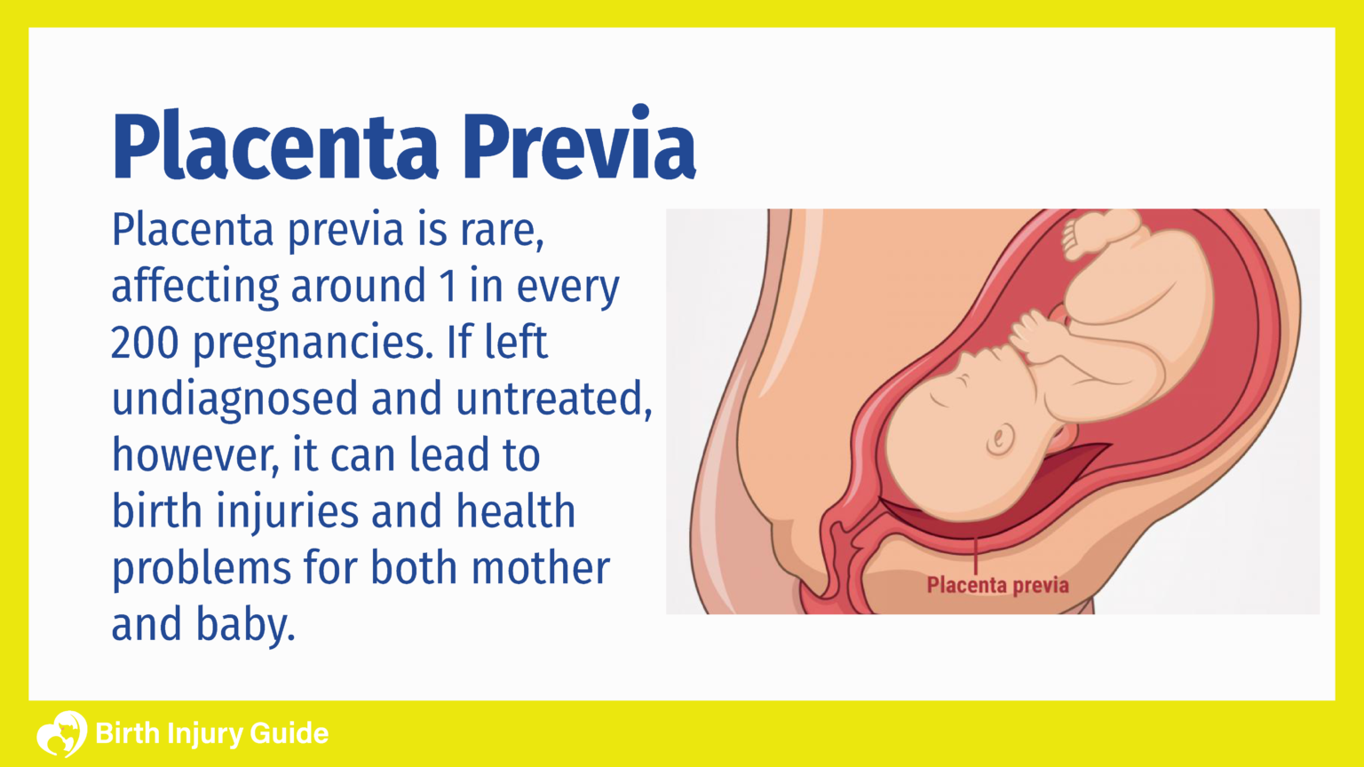 Placenta Previa: Causes, Risk Factors, Treatment | Birth Injury Guide