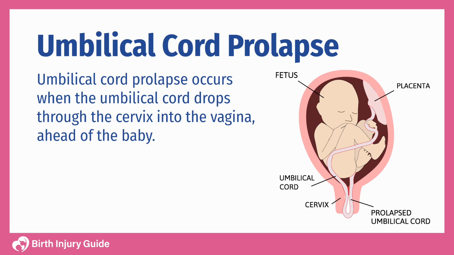 Umbilical Cord Prolapse - Birth Injury Guide